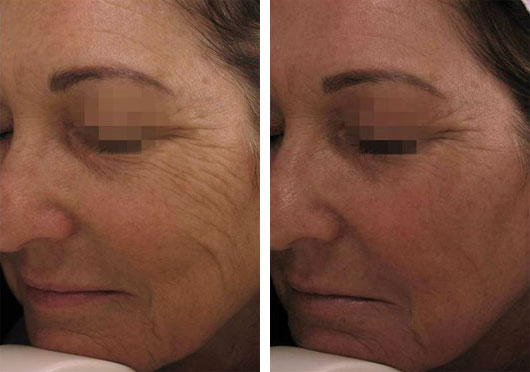 Pearl fractional laser treatment | Facial laser surgery - Milo clinic