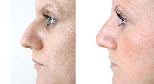 Harley street Non-Surgical Nose Job | Nose fillers - Milo Clinic